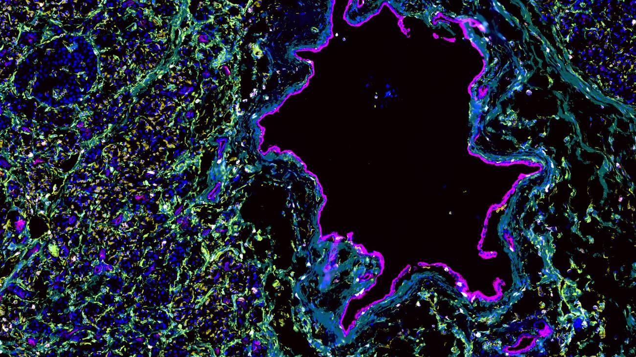 Home | Cancer Grand Challenges